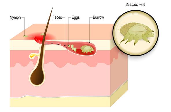La gale : comment la reconnaître et comment la traiter ? | PassionSanté.be